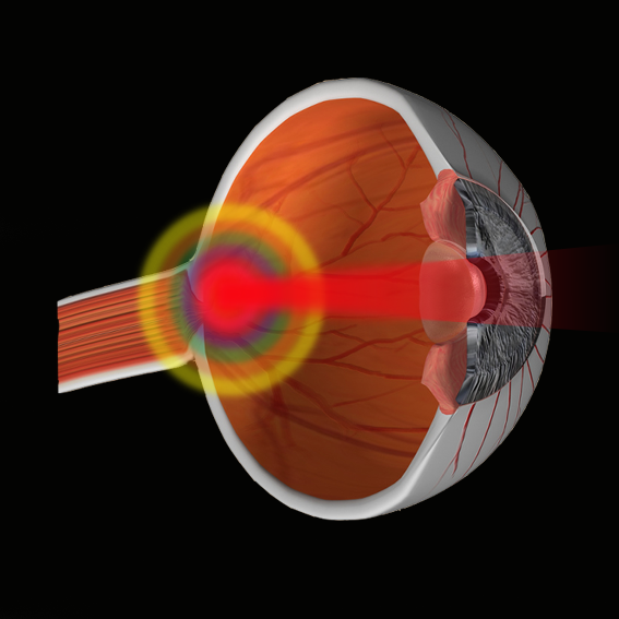 Monitoring Retinal Inflammation by Raman Spectroscopy | ICFO
