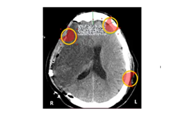 Challenges and solutions for using diffuse optics in brain injury | ICFO